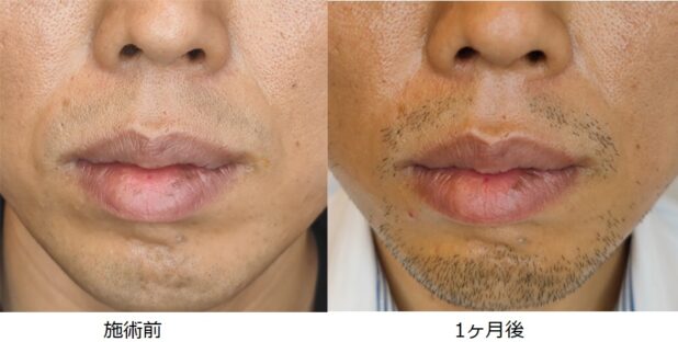 男性のほうれい線を1回で気づかれずに長期間解消する治療